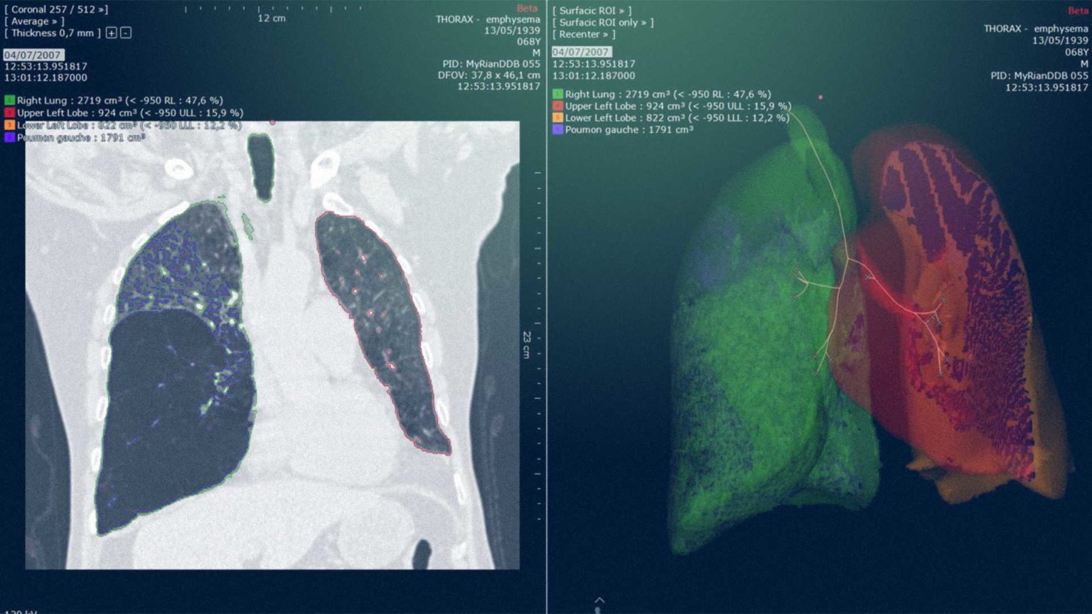 ~ Lungs | Imaging | Intrasense, Myrian® Studio