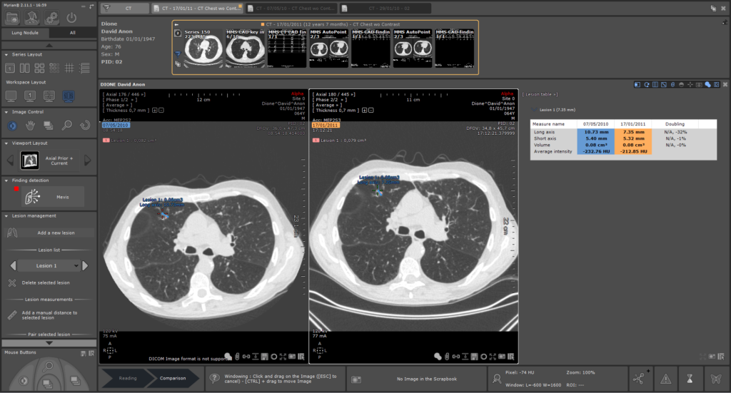 ~ Lungs | Imaging | Intrasense, Myrian® Studio